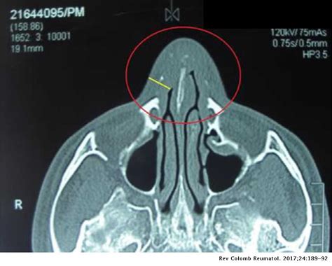 Intranasal Eosinophilic Angiocentric Fibrosis Associated With An Igg4 Related Disease Revista