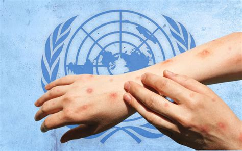 Oms Intenta Transmitir Tranquilidad Ante Brote De Mpox No Es La Covid