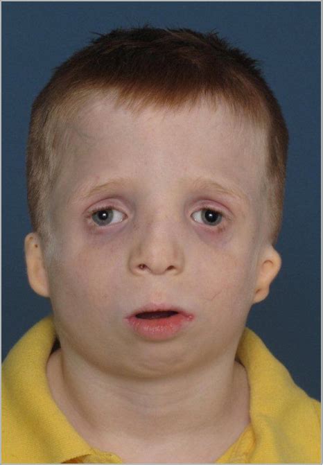 Mandibulofacial Dysostosis Tahiri Plastic Surgery