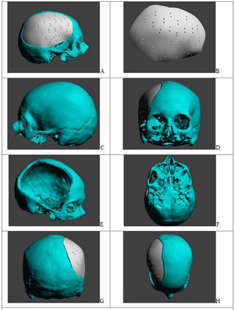 Romania Comparing Additively And Conventionally Manufactured Patient Specific Cranial Implants