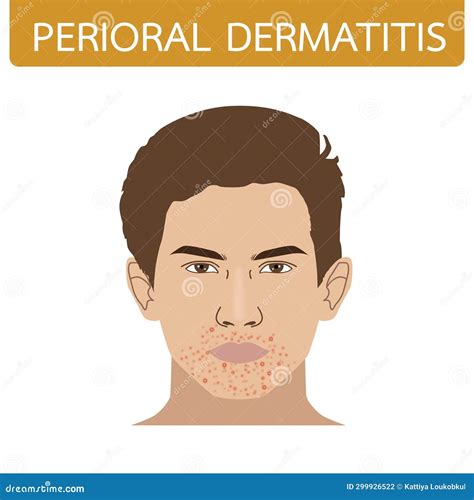 Perioral Dermatitis On Man S Face Allergy Around Mouth Illustration On