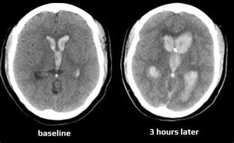 Intraventricular Hemorrhage
