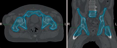 Figure 1 From Dosimetric Comparison Of Intensity Modulated Proton Therapy And Volumetric