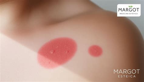 Cómo queda tu piel tras eliminar un tatuaje Resultados y cuidados