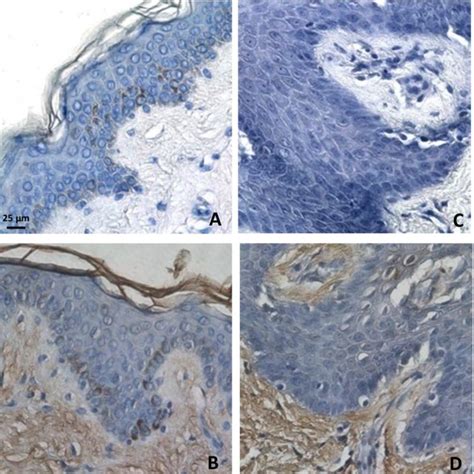 Clinical Manifestations Of Moderate To Severe Chronic Plaque Psoriasis