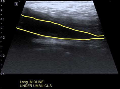 Inflamed Umbilical Urachal Sinus Image