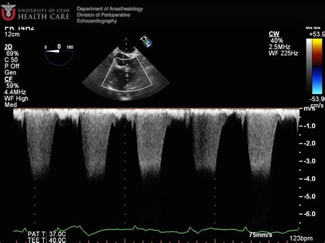 Abnormal Echocardiogram