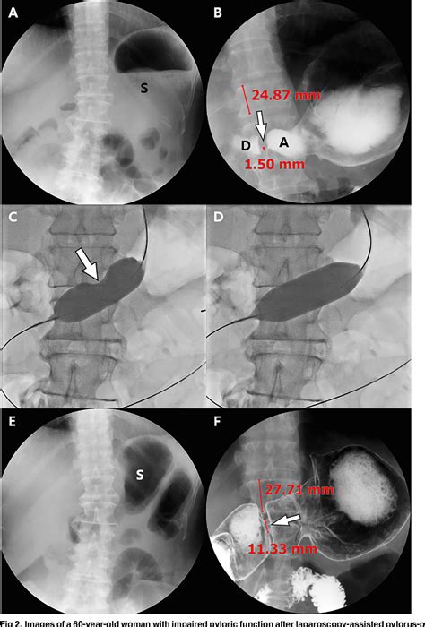 Figure 2 From Efficacy Of Gastric Balloon Dilatation And Or Retrievable Stent Insertion For