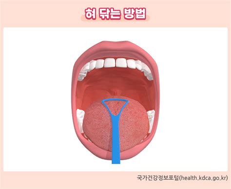입냄새 원인 및 해결방법