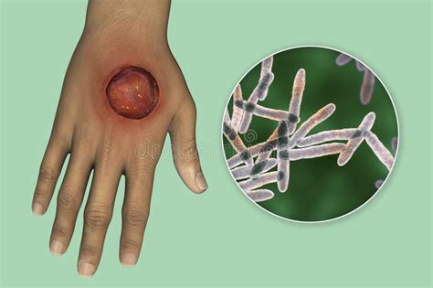 Buruli Ulcer On An Arm 3d Illustration The Disease Caused By