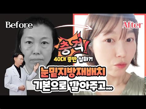 충격 40대 중반 실화 눈밑지방재배치로 달라지다
