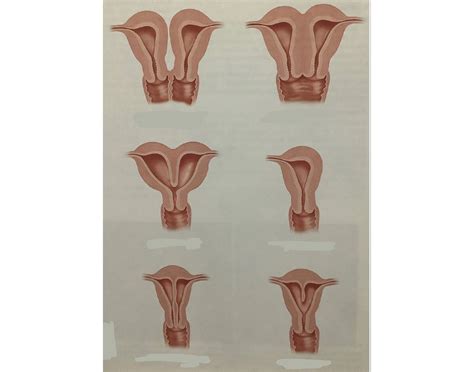 Uterine Anomalies Quiz