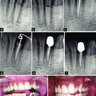 Case A Preoperative Radiograph B Immediate Postsplinting Download Scientific Diagram
