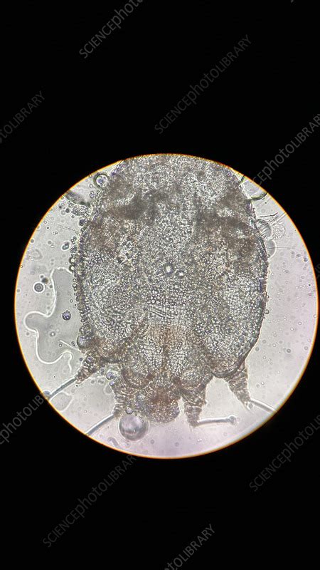 Scabies Mite Dermoscopy Stock Image C0607581 Science Photo Library