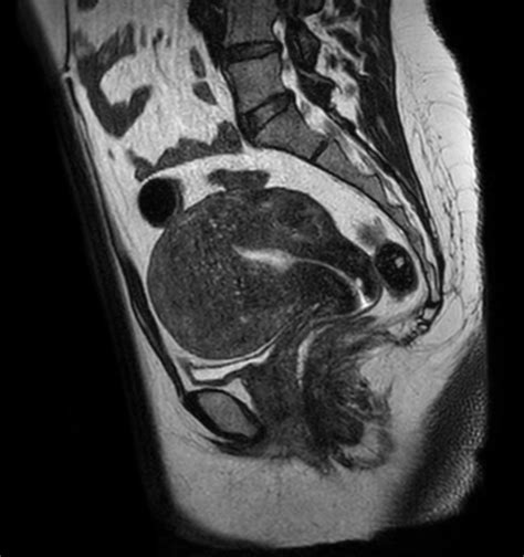 Female Pelvis With Myoma Compressed Sense Philips Mr Body Map