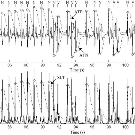 Qrs Detection Algorithm Based On Analysis Of Ecg Signal Amplitudes