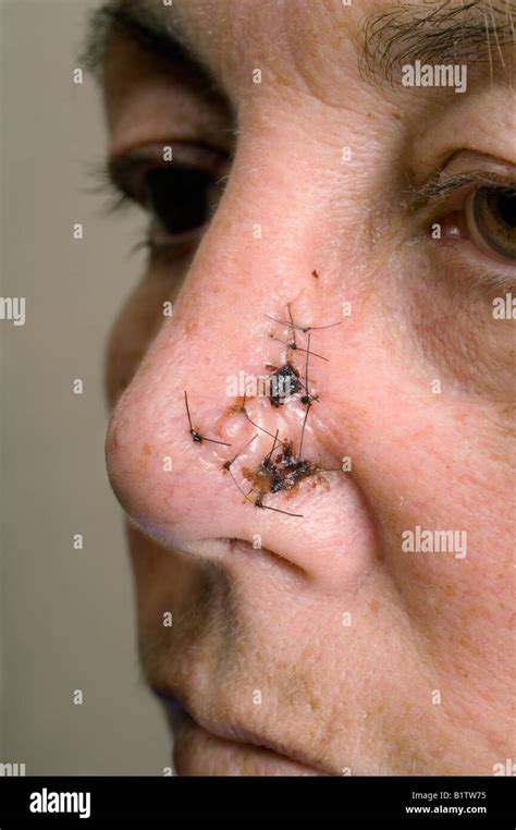 Basal Cell Carcinoma Mohs Surgery Pictures Nose At Julie Lundy Blog