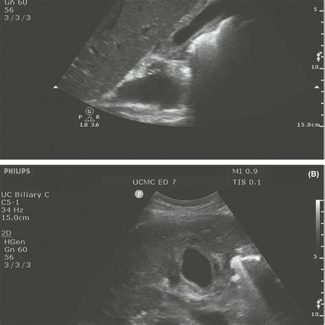 A Case 1 Point‐of‐care Ultrasound Of Gallbladder In A Longitudinal