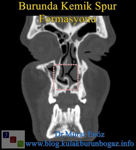 Health Zone Turkey Nasal Bone Spur Symptoms Diagnosis Treatment