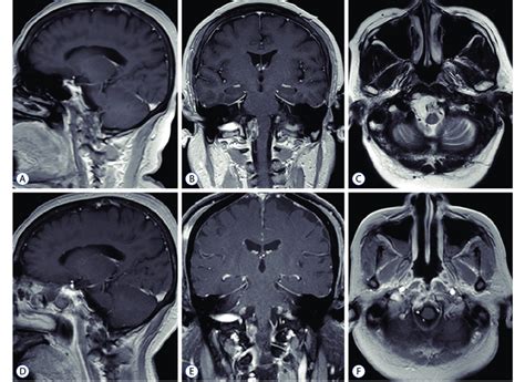 Preoperative Sagittal A Coronal B And Axial C Magnetic
