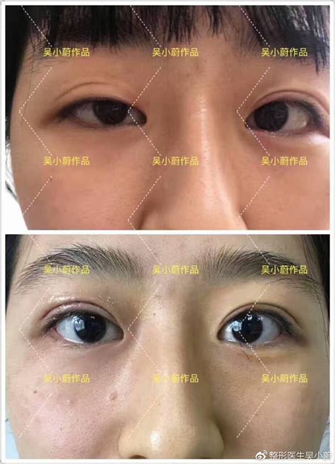 双眼皮修复 那些不漂亮的双眼皮，究竟哪里出了问题？ 知乎