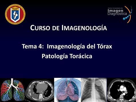 PDF Tema 4 Imagenología del Tórax Patología Torá rax PDF