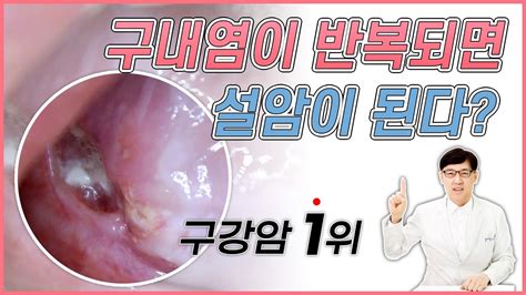 설암은 어디에 많이 생길까 설암 사진으로 초기 증상 알아봐요 Youtube