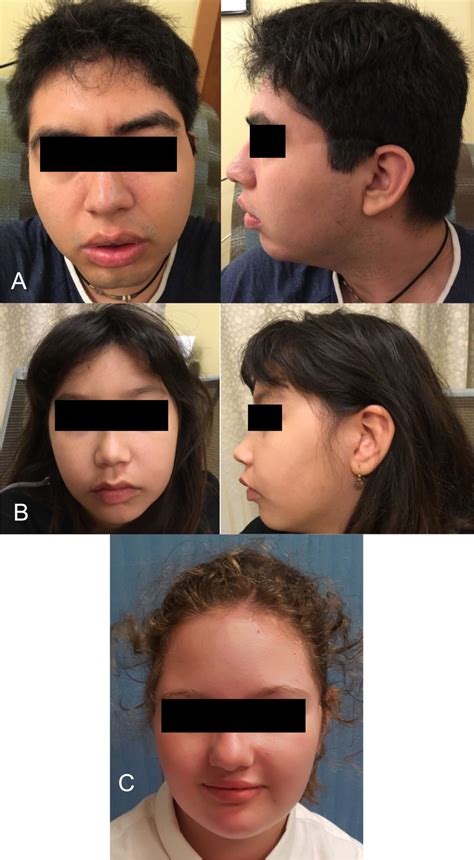 Patient Facial Features A Patient Demonstrated Bitemporal