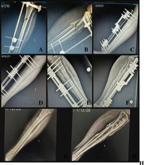 Figure From Tibia Non Union Management Using Limb Reconstruction System Fixator A Case Series