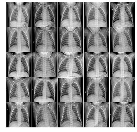 Github Ajaysh Predicting Pneumonia From X Ray Images Using Cnn And Keras