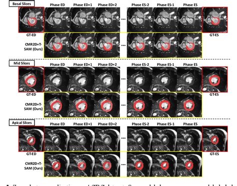 Figure 3 From Cardiac Magnetic Resonance 2dt Short And Long Axis Segmentation Via Spatio