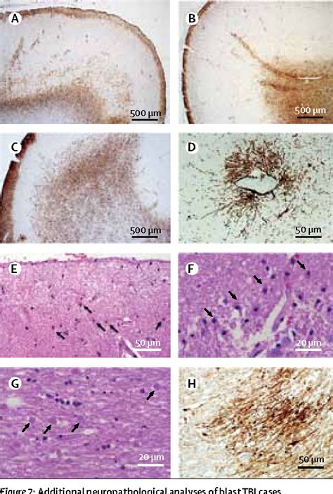 Tympanic Membrane Scarring Semantic Scholar