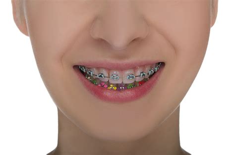 Braces Color Picker Bordentown Braces