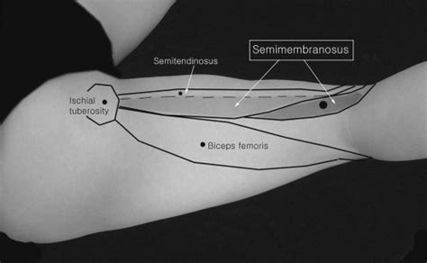 The Buttock And Posterior Thigh Musculoskeletal Key