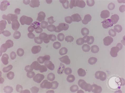 Plasmodium Vivax Gametocytes