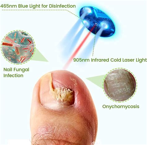 Home Nail Fungus Laser Treatment Device 905nm Infrared And 470nm Blue Light For Onychomycosis