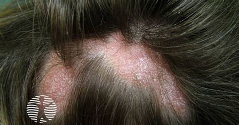 Lichen Planus Image