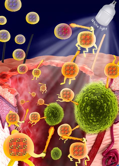 Breakthrough In Wound Healing Using Nanoparticles To Fight Antibiotic