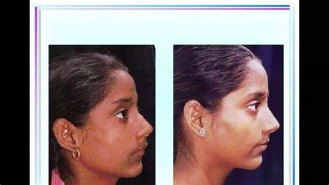 Maxillary Rotation Pptx