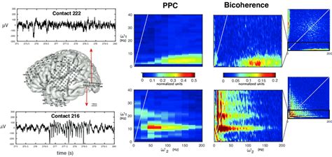 Distinguishing The Origin Of Pac In Human Ecog Data With Bicoherence Download Scientific