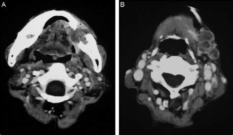 A Computed Tomography Ct Demonstrating Mass Invading Bone And Download Scientific Diagram