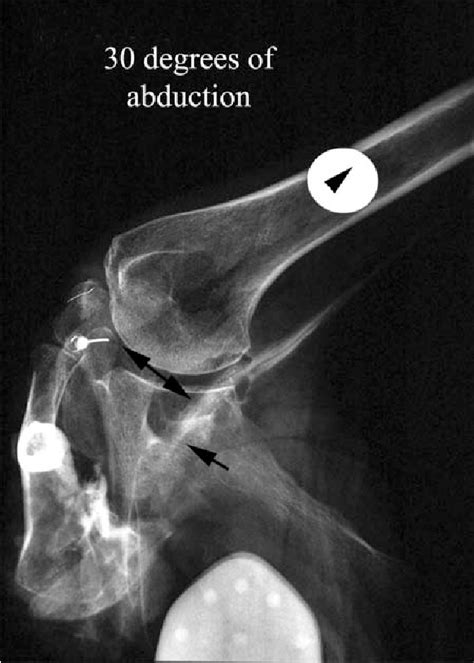 Figure 1 From The Relationship Of The Lateral Cord Of The Brachial