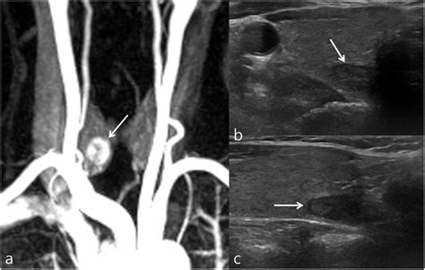 Incidental Hypervascular Thyroid Nodule In A 72 Year Old Female A Download Scientific