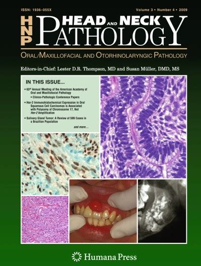Paraganglioma Carotid Body Tumor