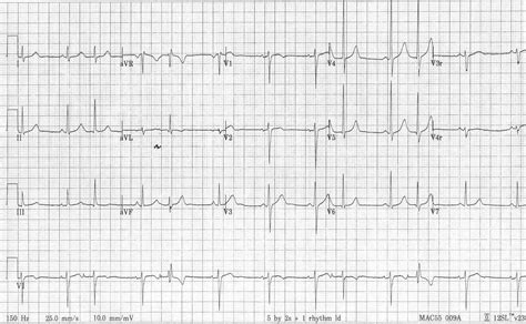 Pedi Cardiology Atrial Ectopy