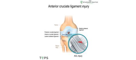 Anterior Cruciate Ligament Injuries What You Need To Know Tops