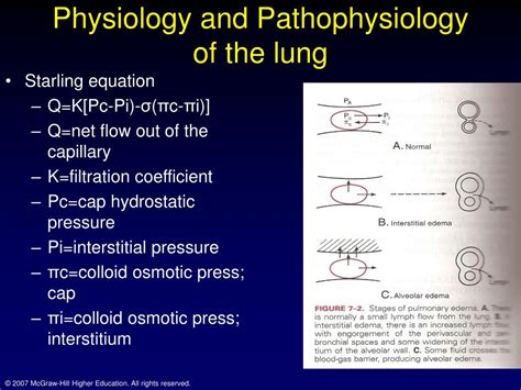 Ppt Chapter 7 Pulmonary Edema Powerpoint Presentation Free Download