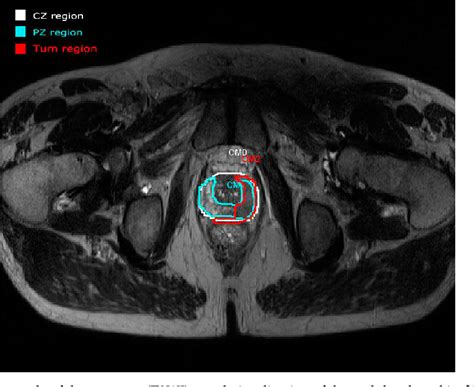 Figure 2 From A Prostate Mri Segmentation Tool Based On Active Contour Models Using A Gradient