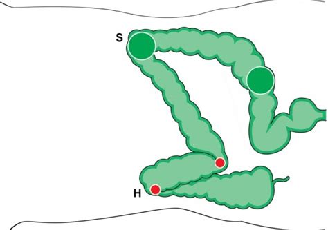Hepatic Flexure Intubation Colon Explorer