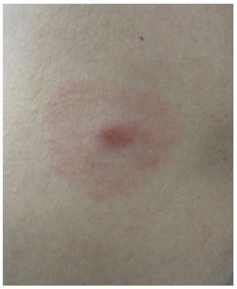 Erythema Marginatum Vs Erythema Multiforme